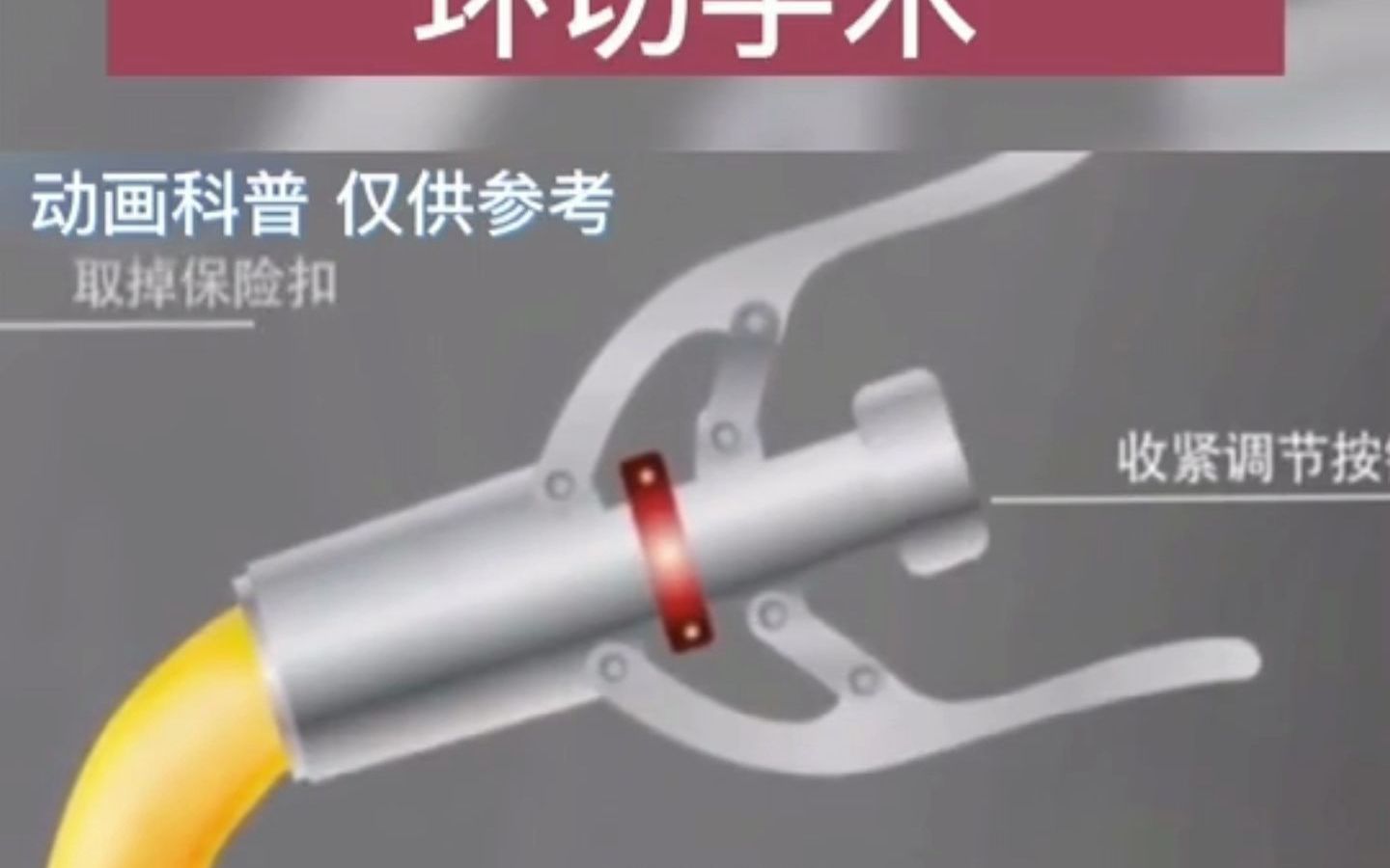 河池曙光医院丨新科技包皮是怎么割掉的呢?