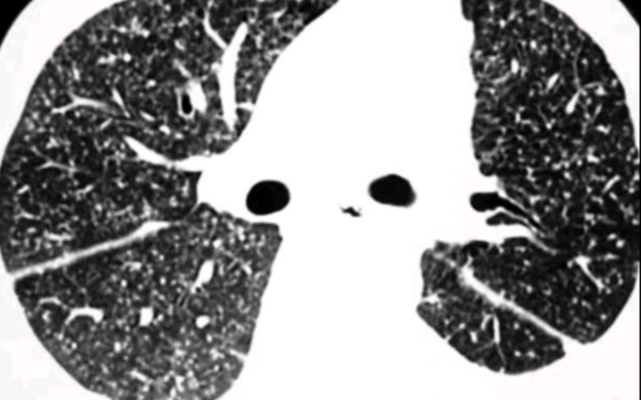 呼吸系统:肺结核影像学表现讲解。