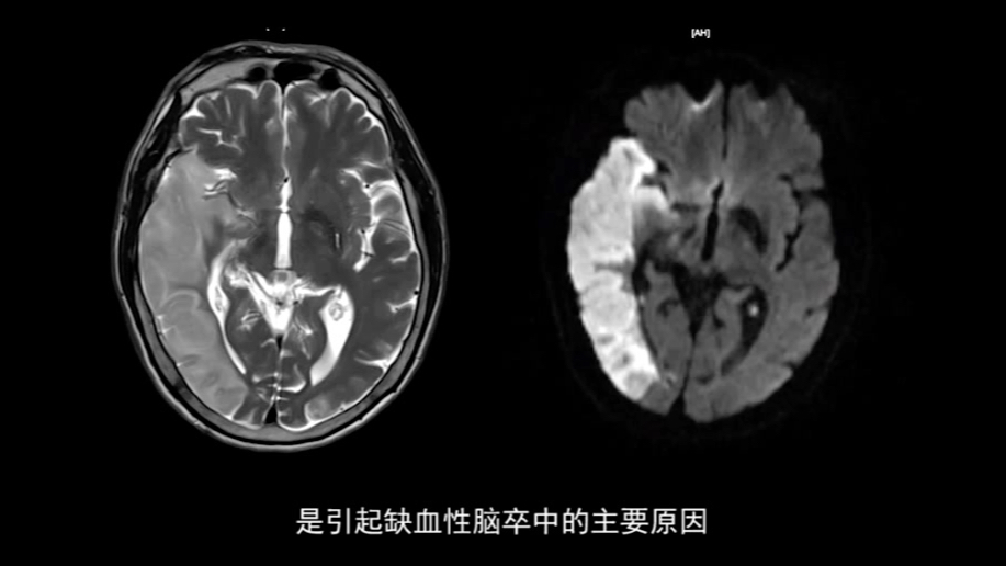 颈部血管动脉粥样硬化的检查及诊断要点(自学)