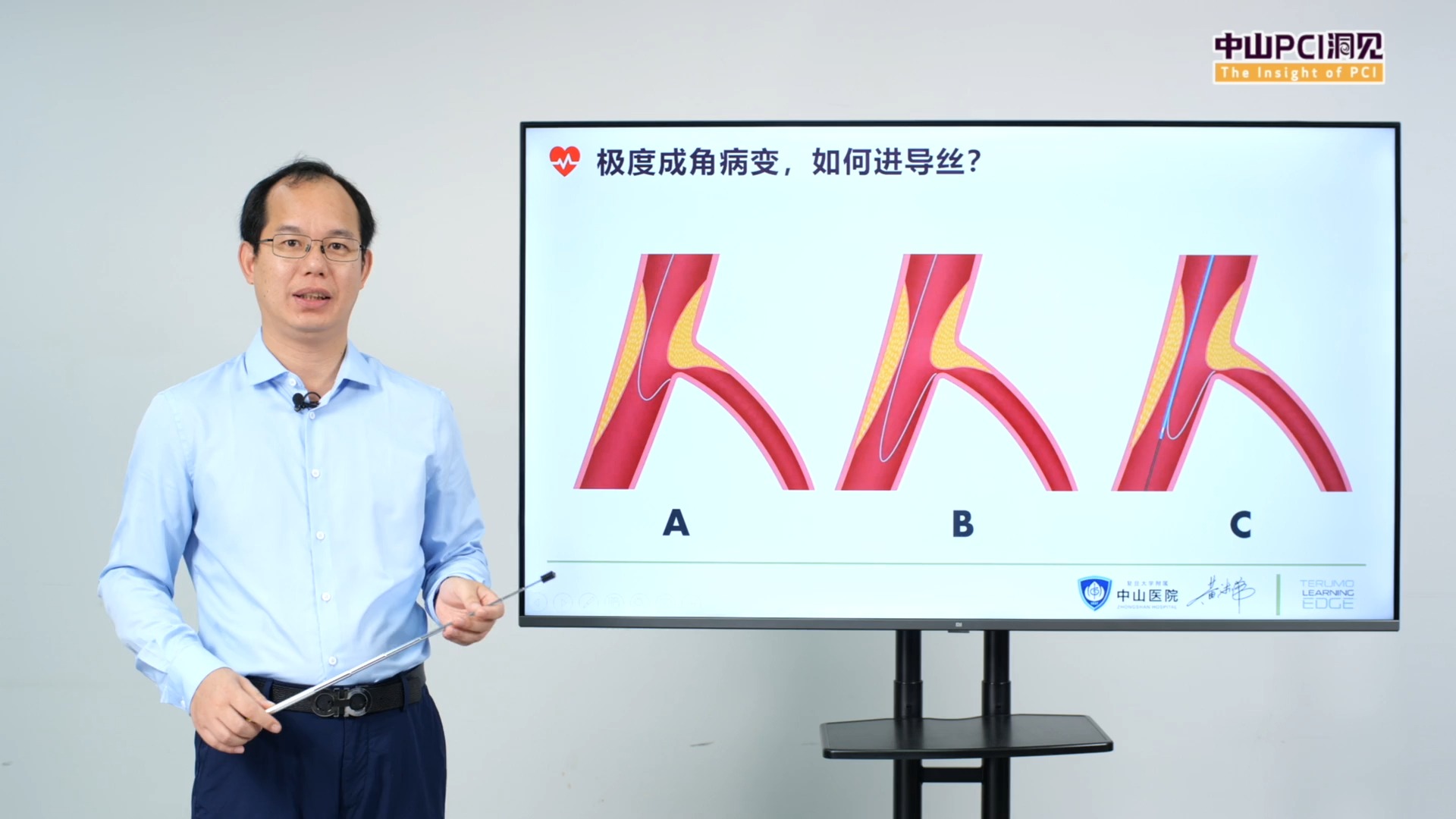 中山PCI洞见 01. 极度成角病变,如何进导丝?