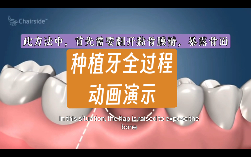 【中英字幕】种植牙全过程动画演示(二期种植-埋入式种植)