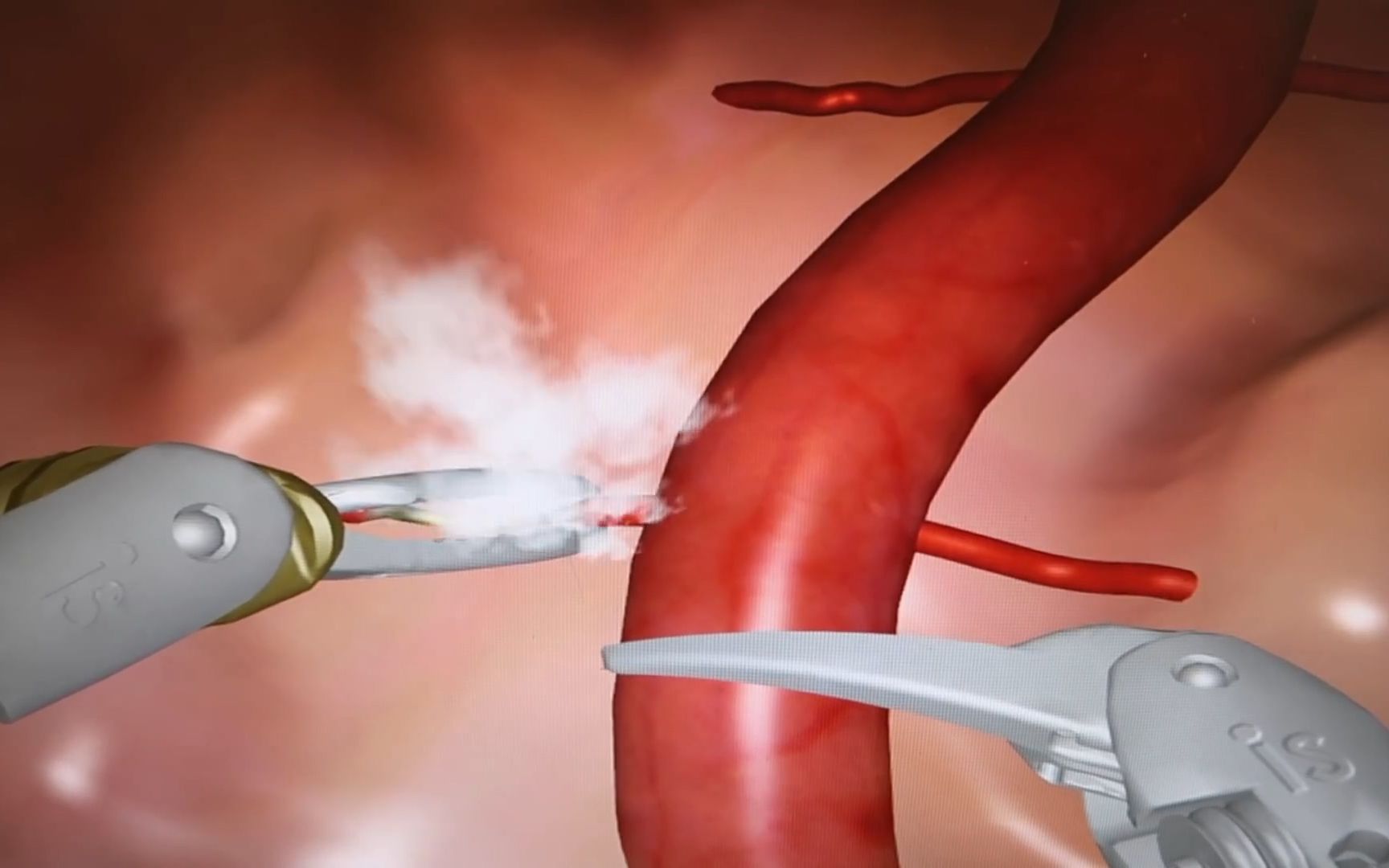 达芬奇手术机器人模拟器医生实操练习(人工翻译双语字幕)