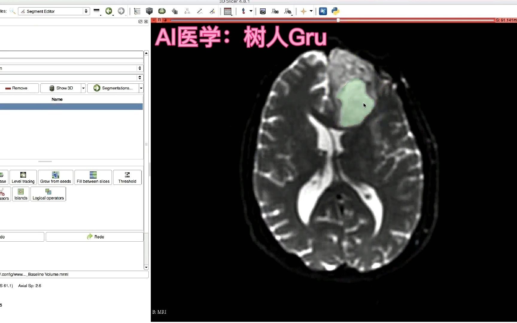 AI医学:基于Slicer的影像组学特征提取