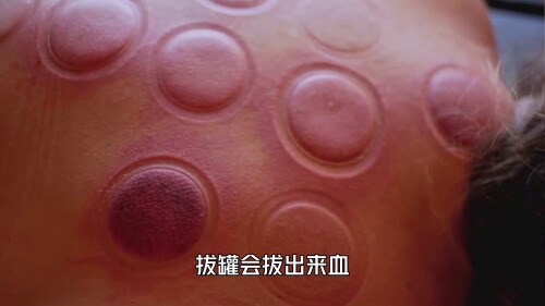 为什么拔火罐会出现淤血呢?你知道拔火罐后,有什么禁忌吗?