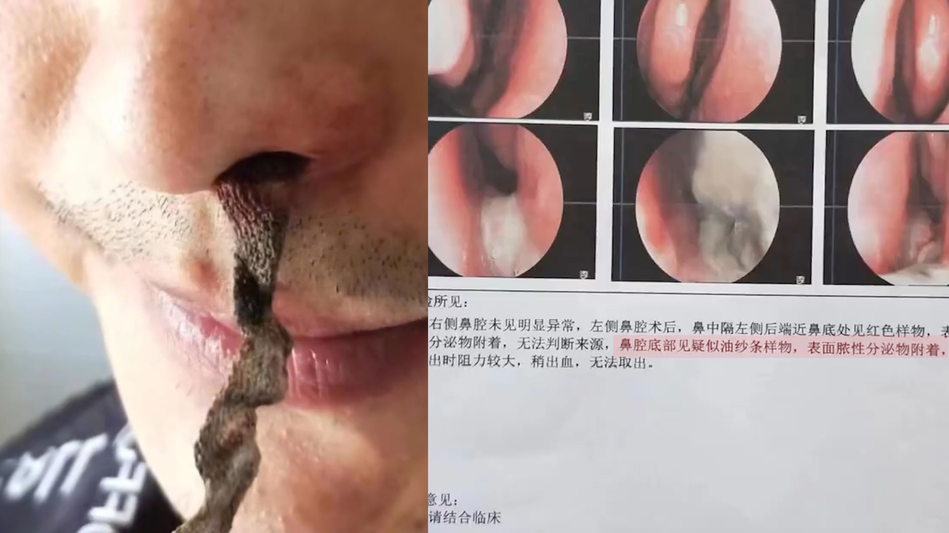 12cm手术纱布遗留男子体内14年:擤鼻涕拉出,欲申请医疗事故鉴定