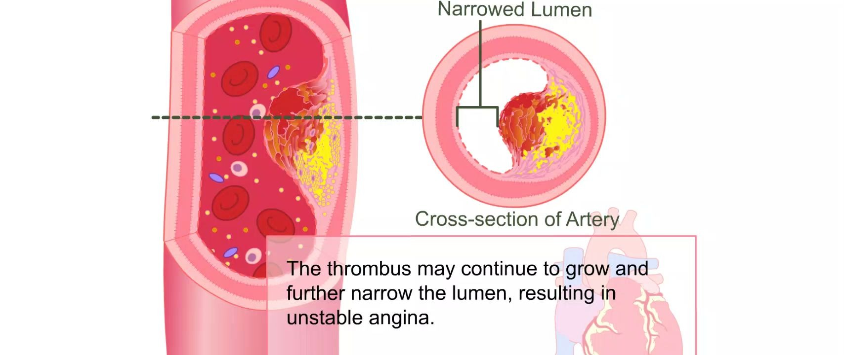 动脉粥样硬化的形成.swf