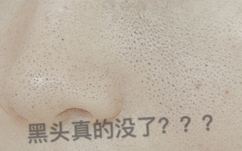 【水杨酸】+【清洁面膜】+【精油按摩】就能让黑头真的消失？？？