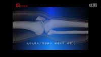 一次性骨牵引器操作视频