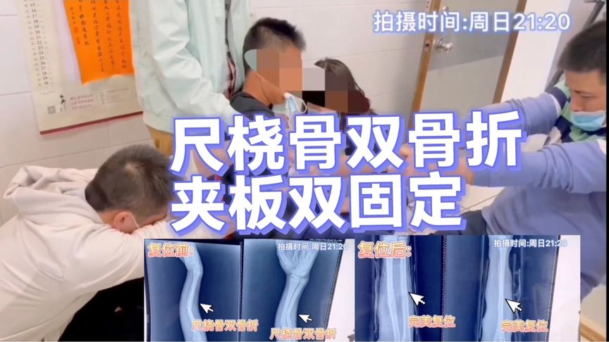 13岁小屁孩打篮球摔倒手部,尺桡骨双骨折,完美复位用双夹板固定