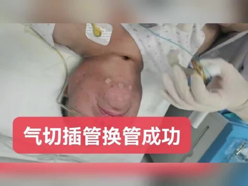 呼吸机脱机成功,气切插管换管成功