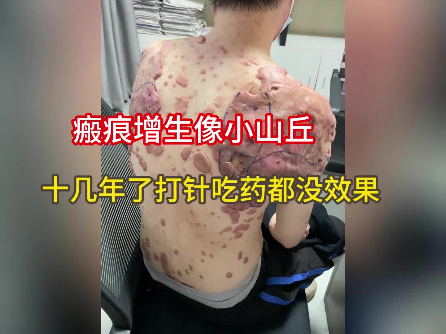 大面积的疤痕增生,十几年打针吃药都去不掉,手术过程很酸爽