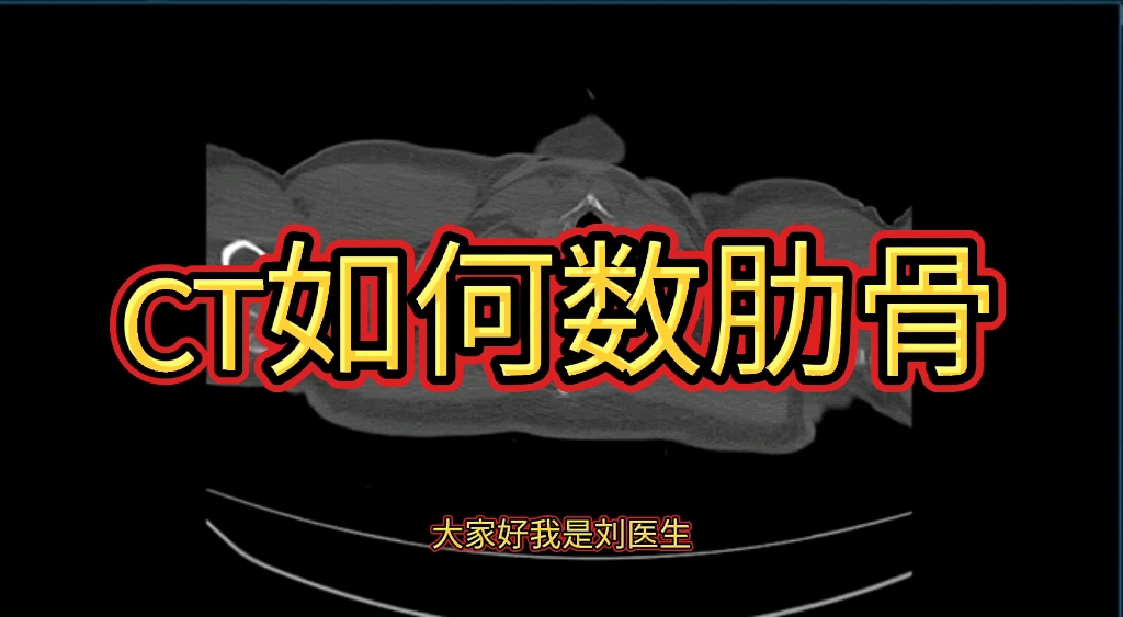 如何在CT图像上数肋骨?放射科医生讲解,简单易懂!