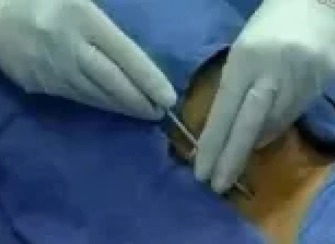 美斯坦福经颈静脉穿刺插管术
