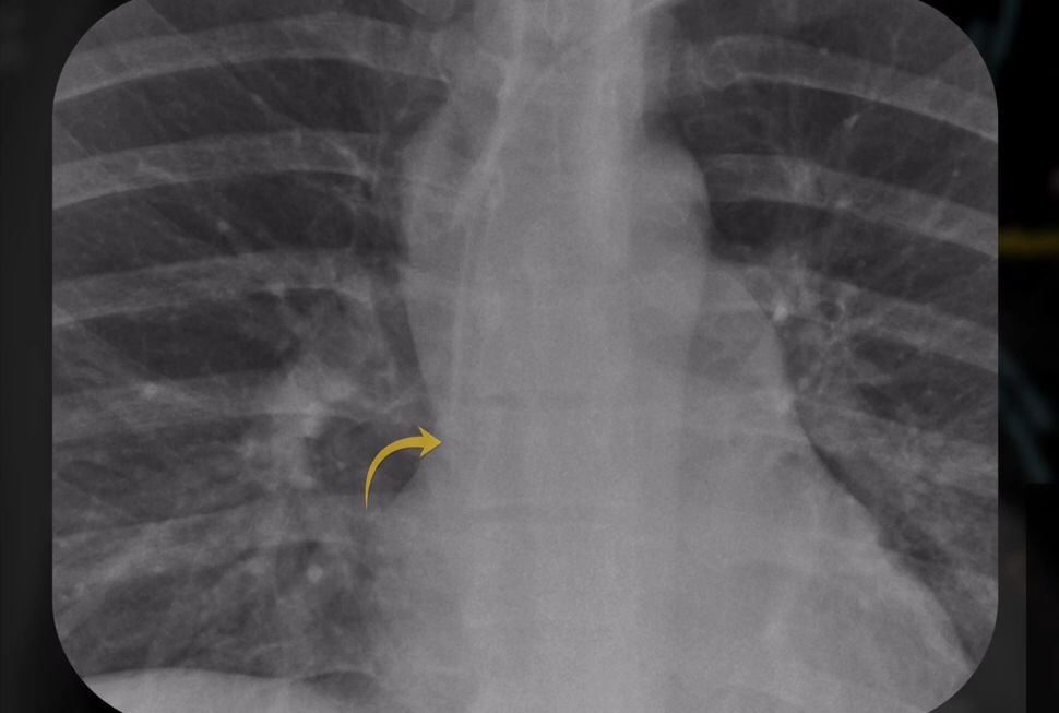 胸片--如何精准判断中心静脉导管的位置