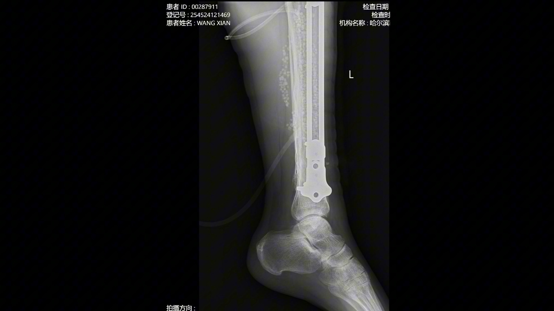 左胫骨骨髓炎开窗扩创抗生素载体置入外固定术