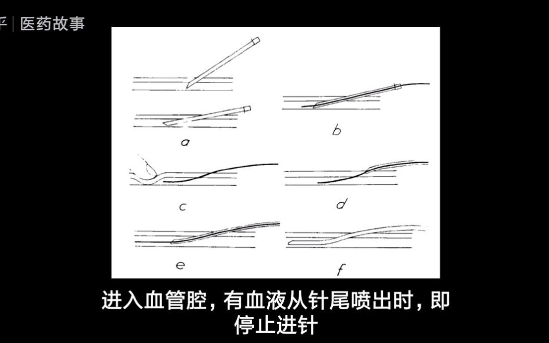 赛丁格与微插管鞘技术