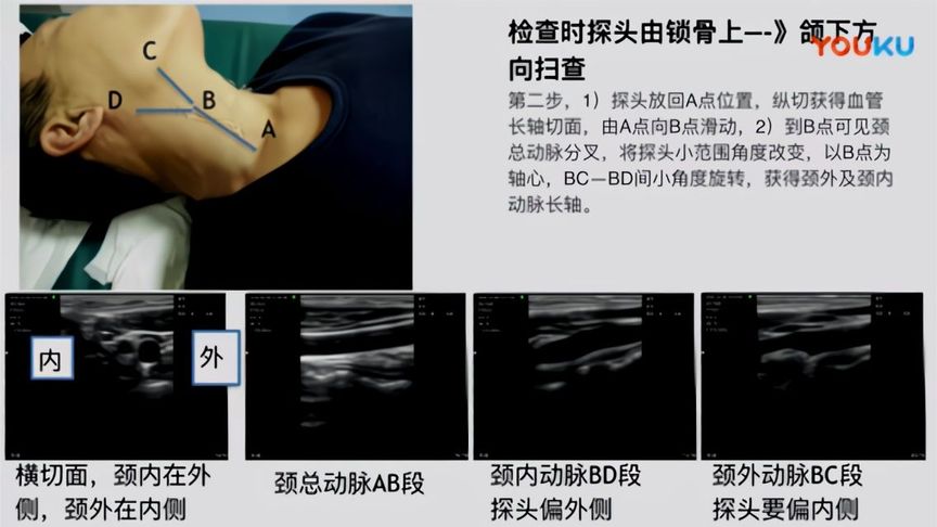 于医生给大家做颈部血管彩超操作讲解了,快来看看吧