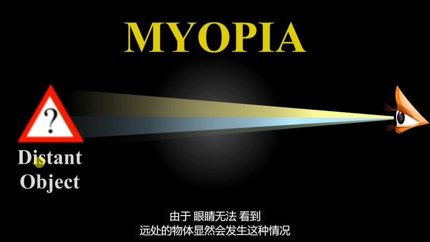 眼睛科普视频告诉你:什么是近视?
