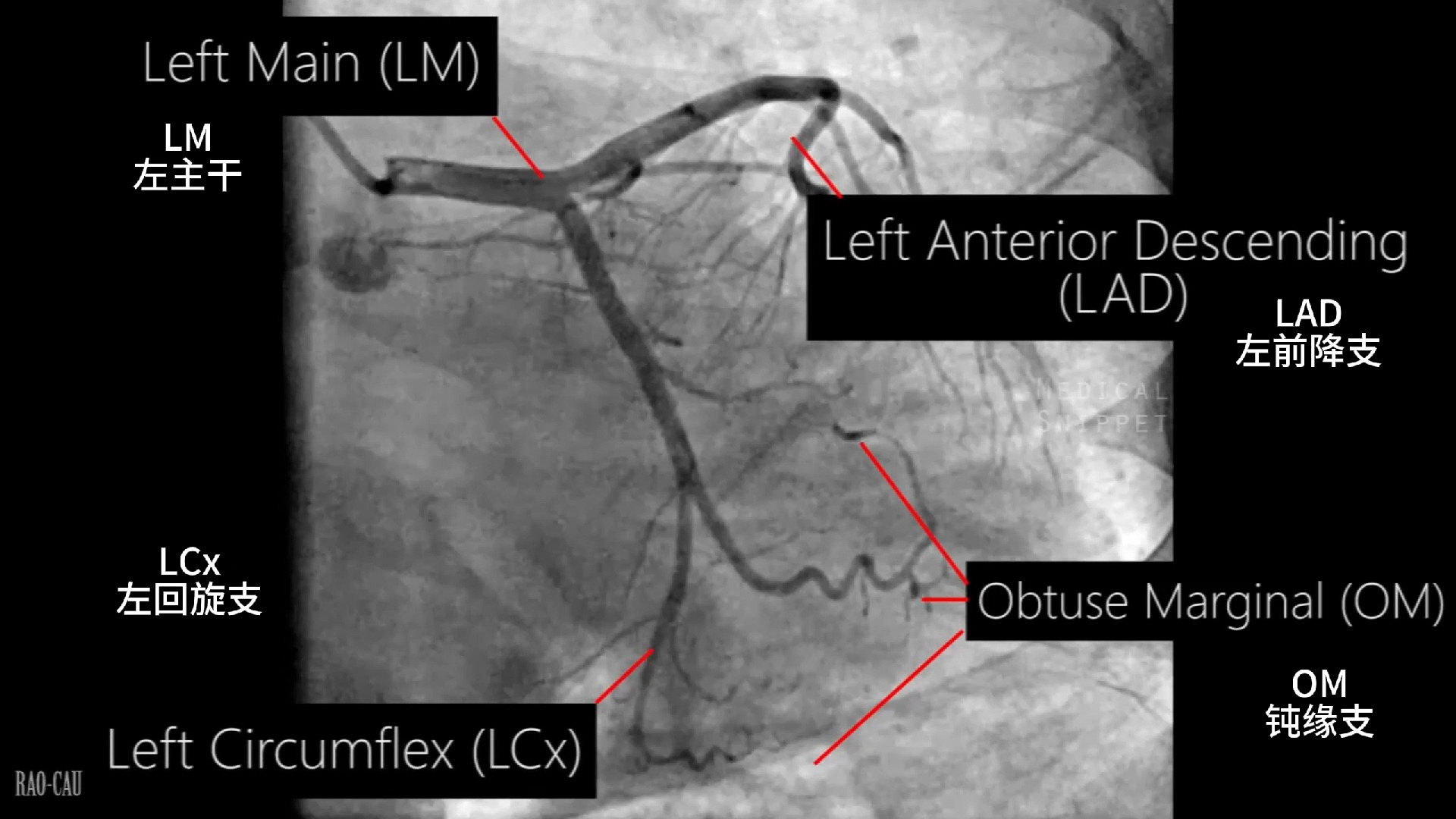 【影像】 冠状动脉造影中的冠状动脉分支
