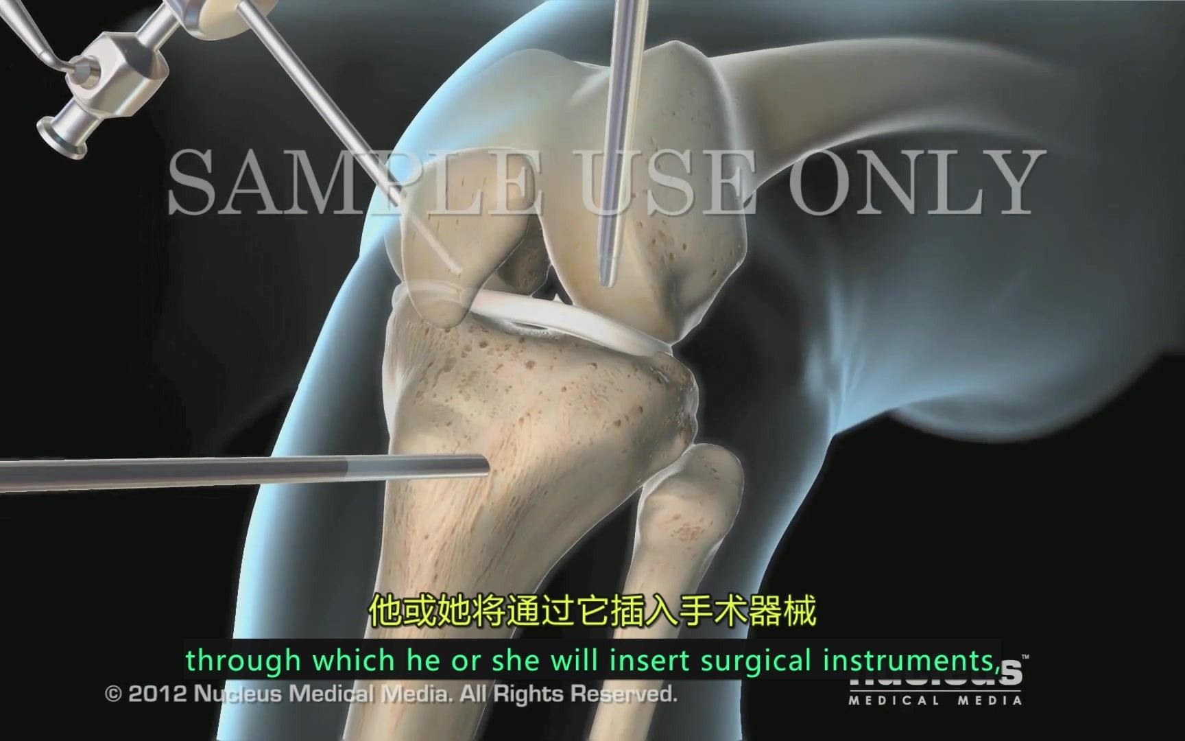 【3D医学动画】千万不要自行代入!前交叉韧带撕裂与修复(中英双字幕)