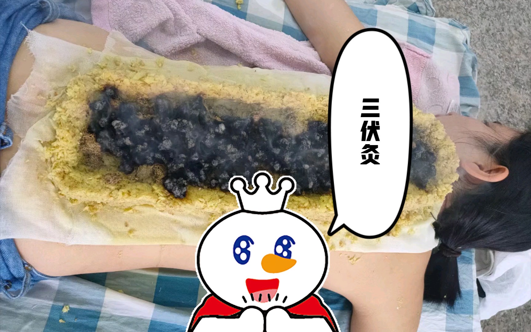 中医传统保健:三伏灸-督脉灸(长蛇灸)