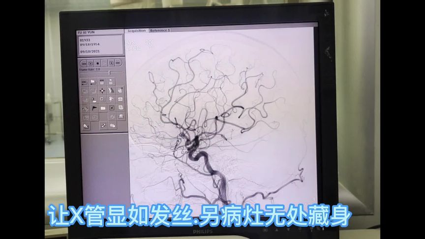 #医路同行助力健康 #介入科 #高压注射器
