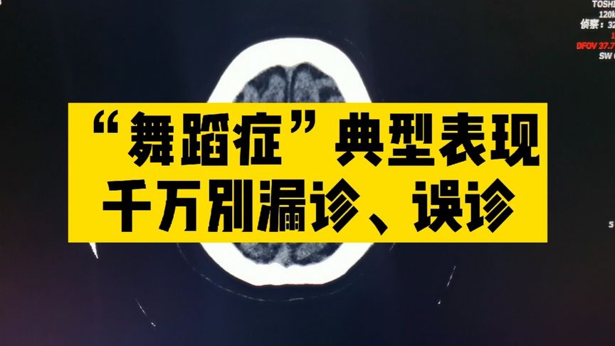 糖尿病患者不自主运动,诊断“舞蹈症”典型CT、MR表现,别漏诊!