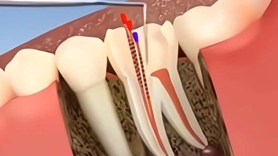 南京根管治疗一颗牙多少钱?根管治疗费用解读!
