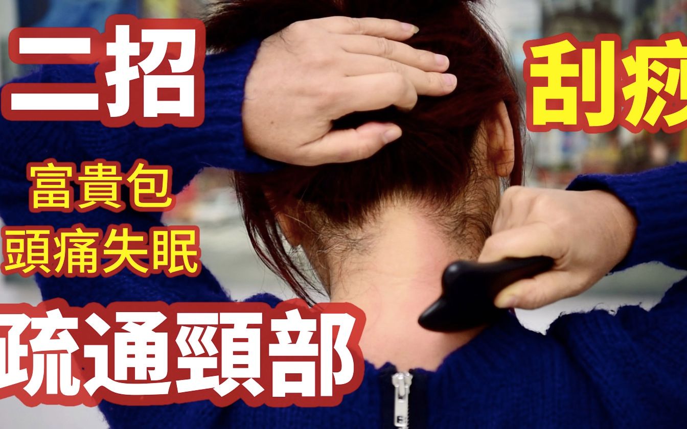 颈部脖子刮痧消除富贵包