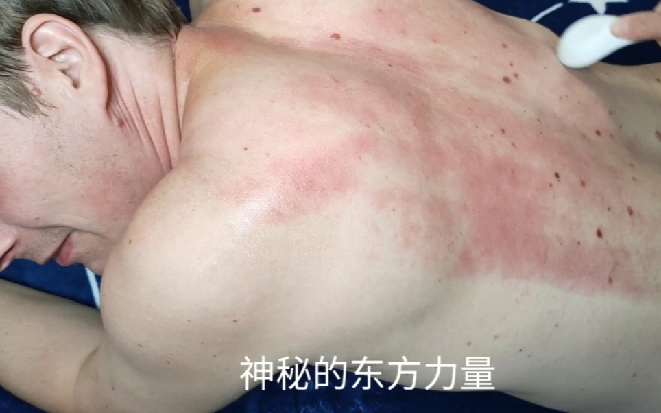 德国大叔感冒了,在家体验刮痧治感冒