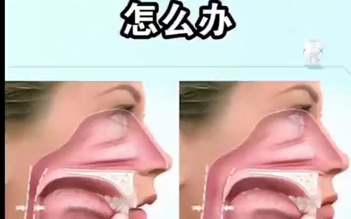 莆田下颌后缩呼吸道狭窄怎么办?也可以这样解决