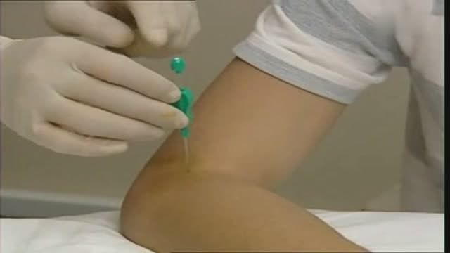 脉络-中医艾灸针灸取穴-微创穴位埋线疗法操作说明及实况(英文)