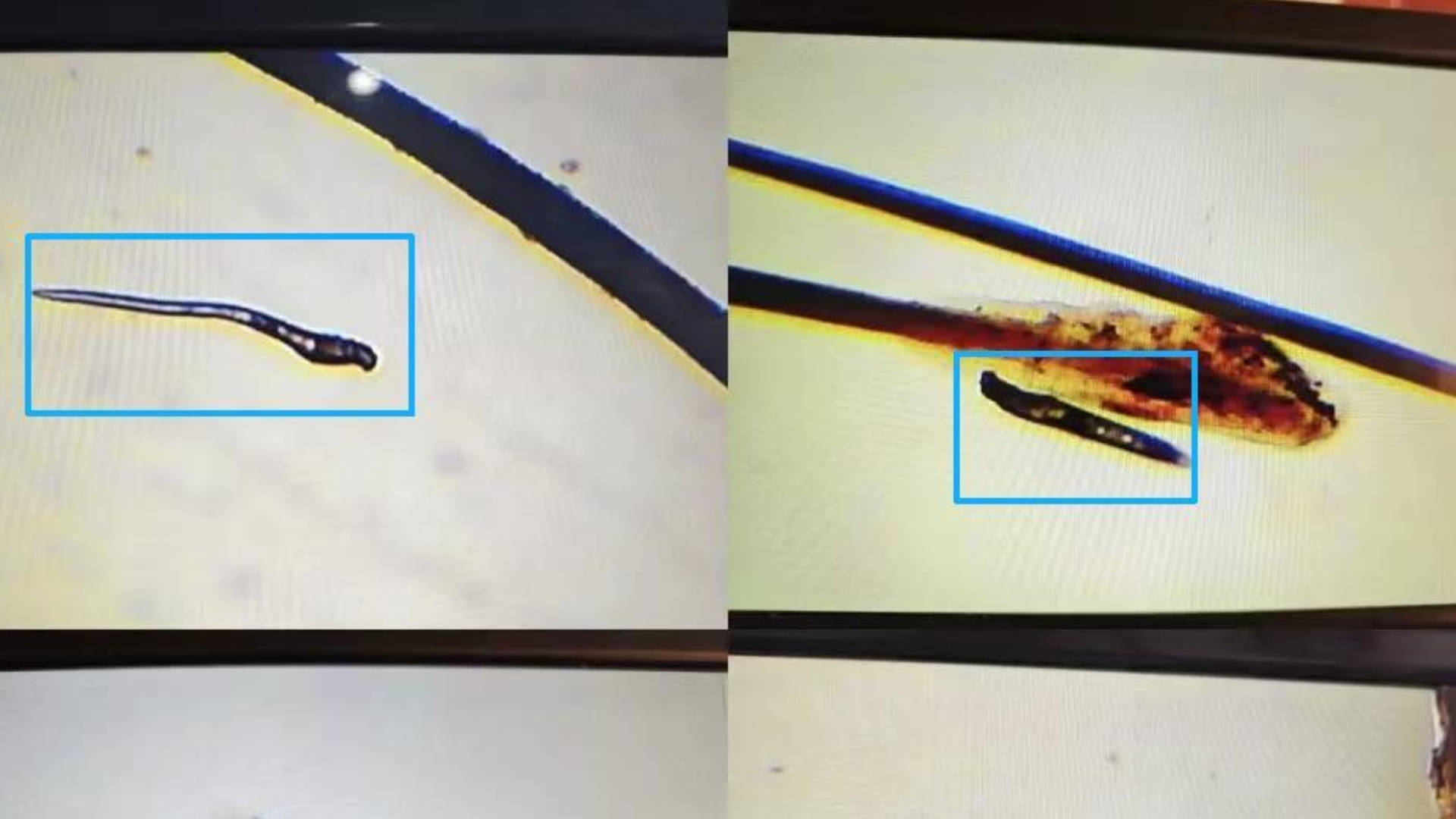 爱美女士化妆后眼痒难忍,竟是睫毛里藏了6条螨虫!