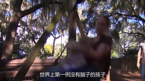世界上第一例没有脑子的孩子,医生建议安乐死,结果两岁出现奇迹