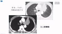 160701诊疗规范2第二章:肺部癌症的影像学表现