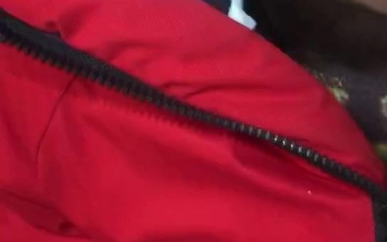 河南南阳小朋友扁桃体肥大,灼烙技术治疗一个疗程康复