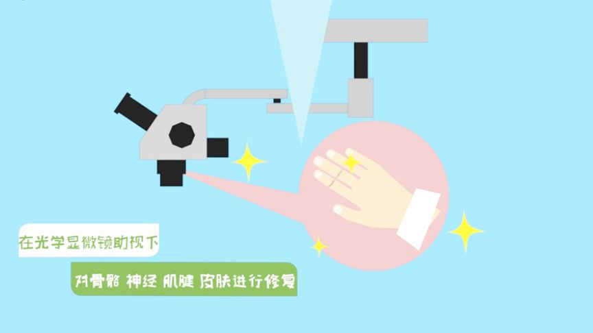 断指再植的手术过程是怎样的?术后一般多长时间会基本愈合?