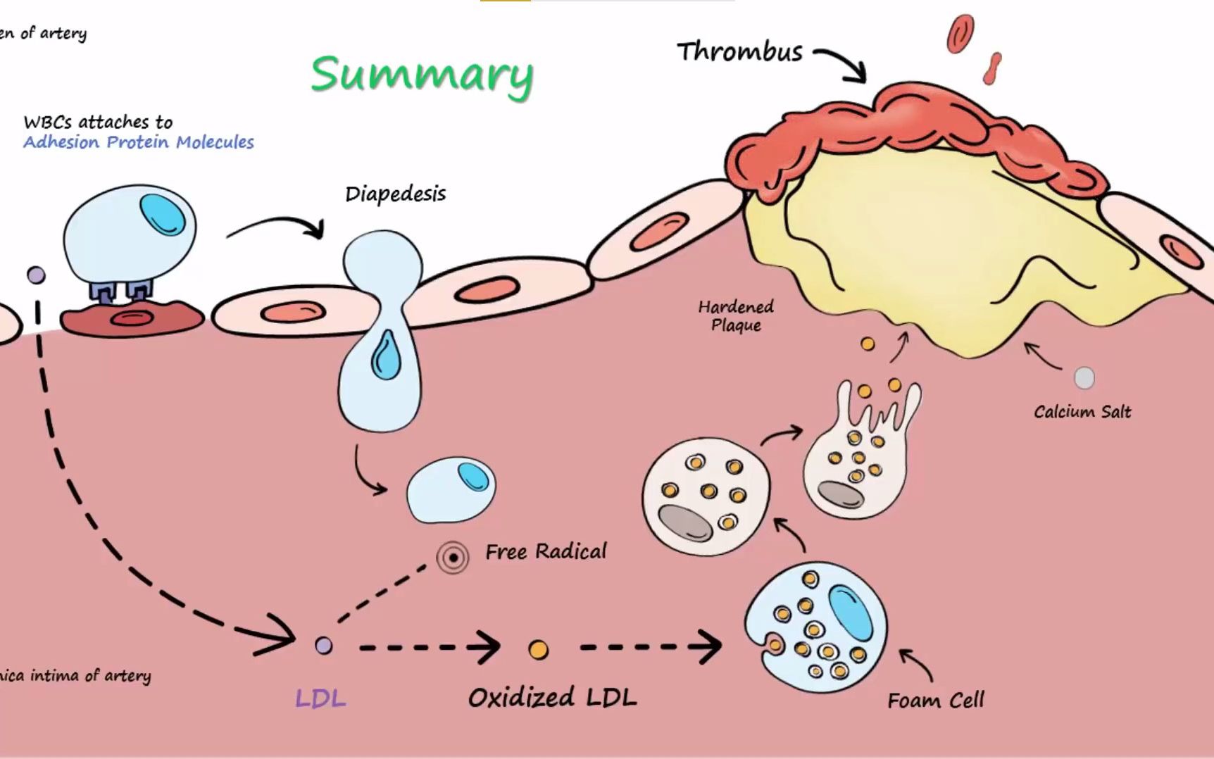 [英文字幕] 动脉粥样硬化是什么?What is atherosclerosis?