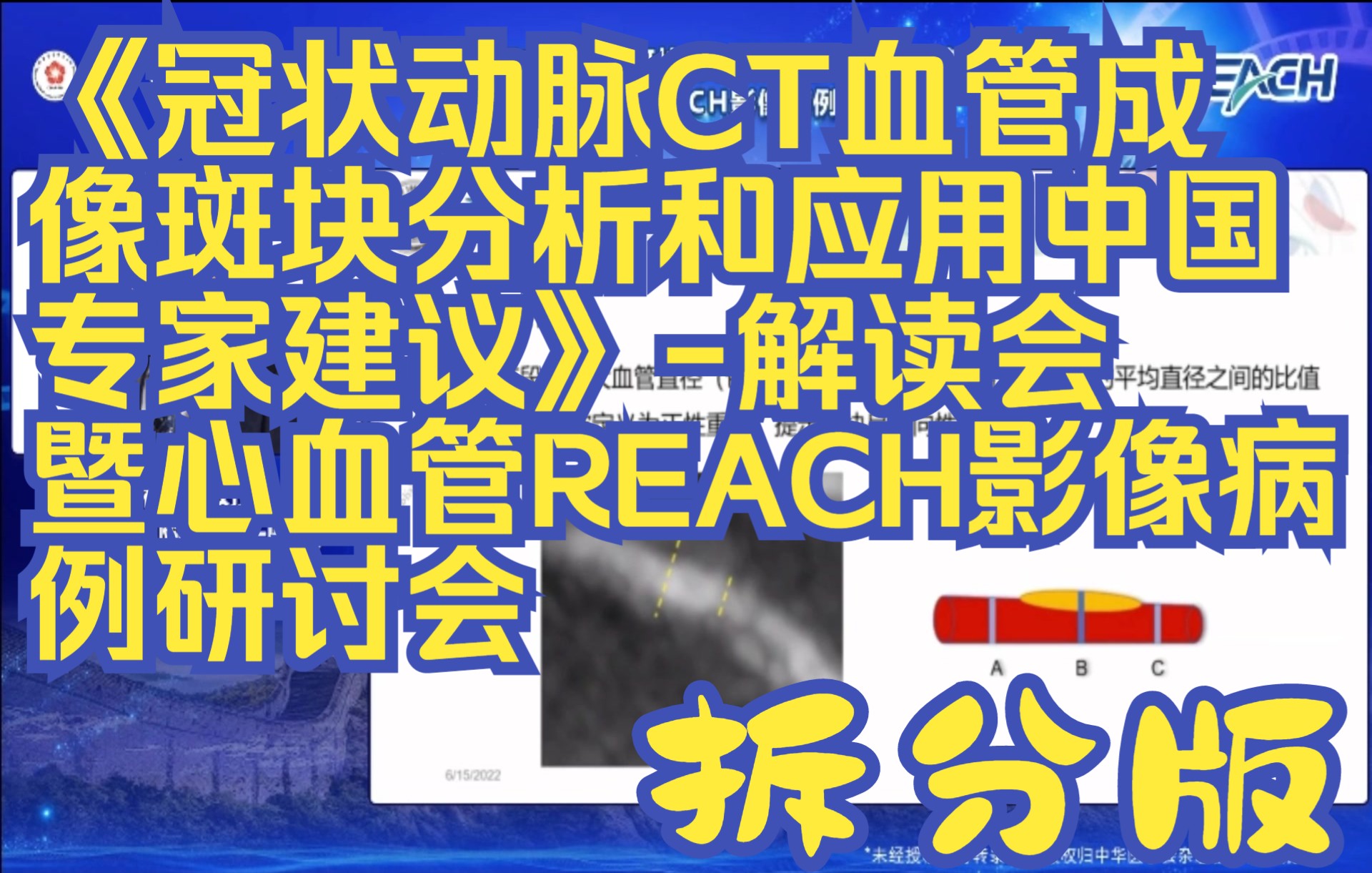 【冠状动脉CT血管成像斑块分析和应用中国专家建议】解读会-拆分版