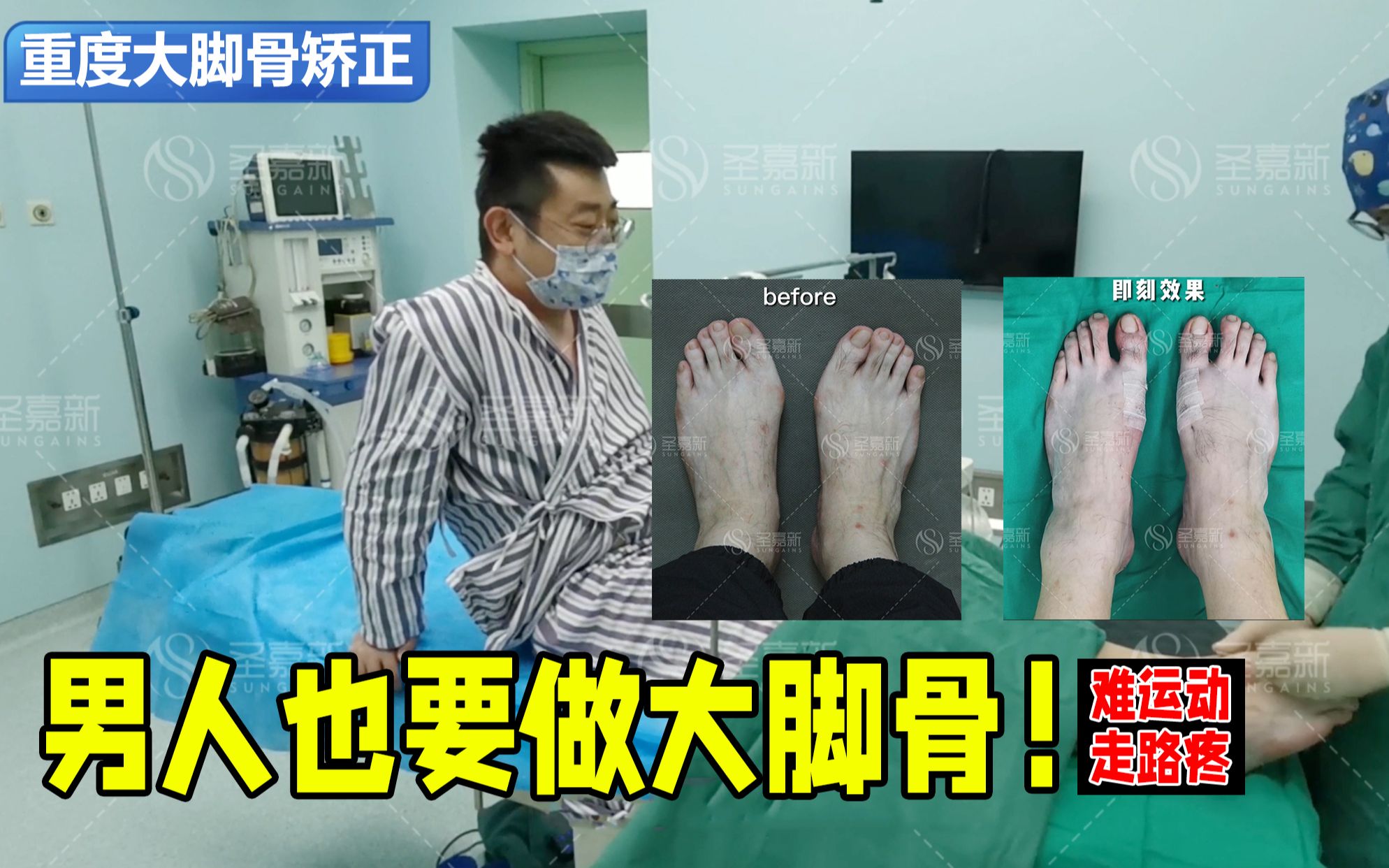 北京苏敬达医生:男生重度拇指外翻矫正:走路疼,不能运动,太痛苦了!
