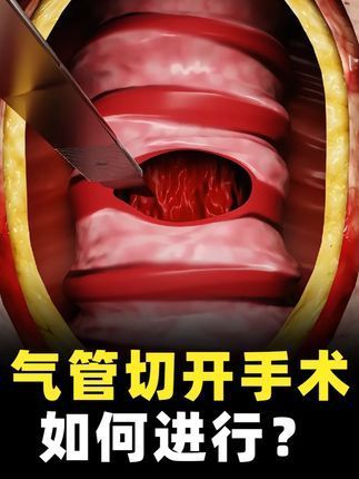 气管切开手术如何进行的?科学的力量太强大了!