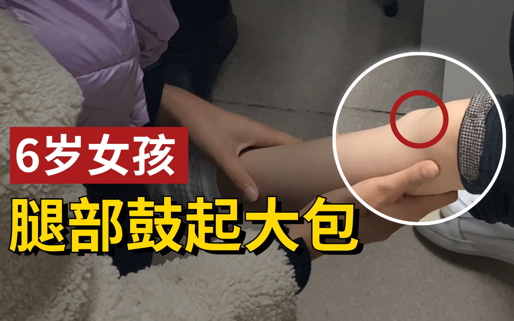 腿部长了个大包,检查后才发现是肿瘤,医生:你这个当妈的太粗心了