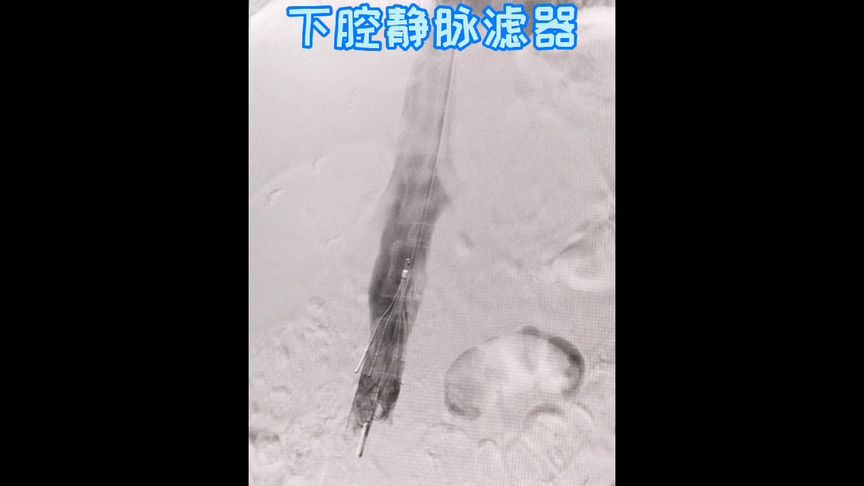下腔静脉滤器取出过程实例分享