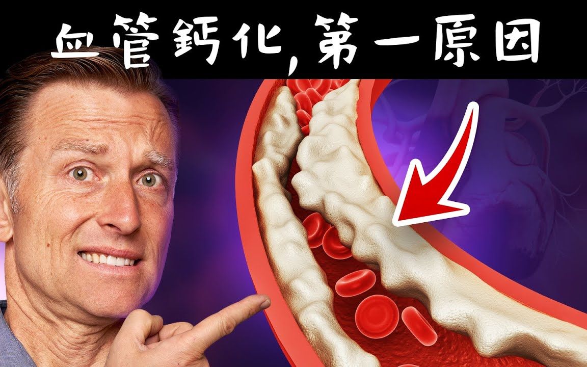 血管鈣化硬化,第一名被忽視的原因,自然療法,柏格醫生 Dr Berg