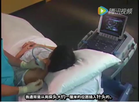 【搬运】超声引导下肌间沟臂丛神经阻滞