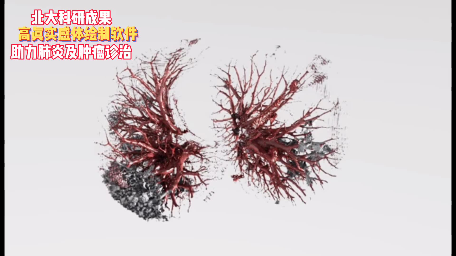 【厉害了】北大医学视觉技术新突破:彩色3D影像直观呈现肺炎病变