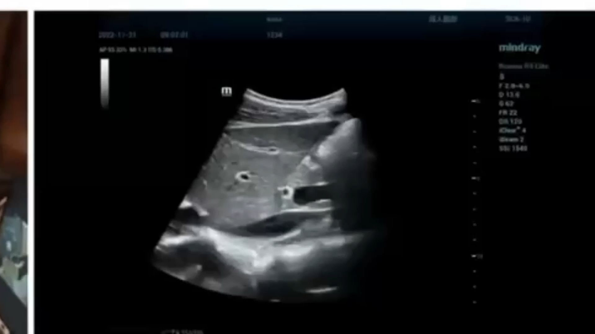 介入超声实操演示