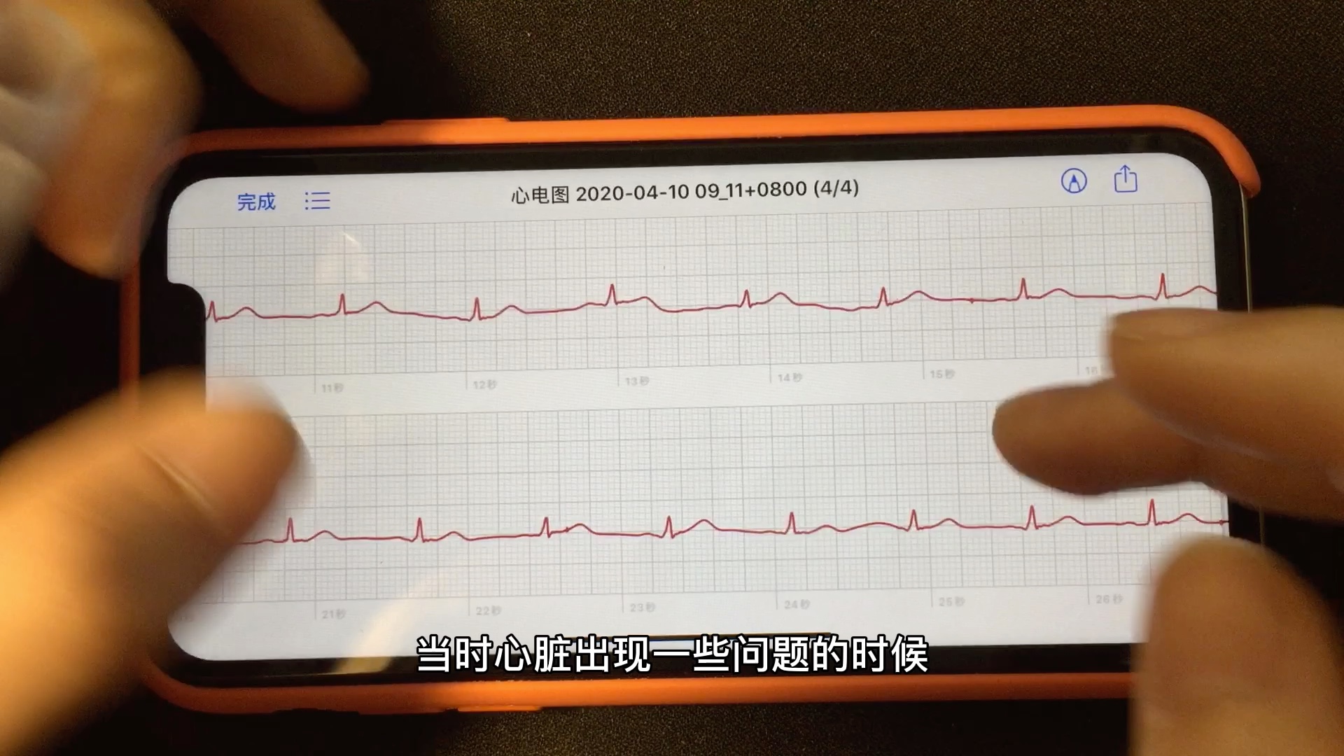 临床医生体验讲解Apple Watch心电图功能