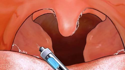 咽拭子真相揭秘:不是取唾液?采样正确姿势一次说清!