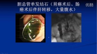 160504消化第一章:ERCP在胆道疾病中的应用